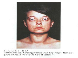 Hyperthyroidism Face