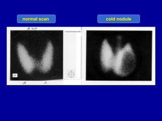 Diseases of thyroid gland | PPT