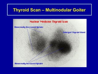 Diseases of thyroid gland | PPT