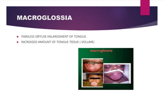 Diseases of tongue | PPTX