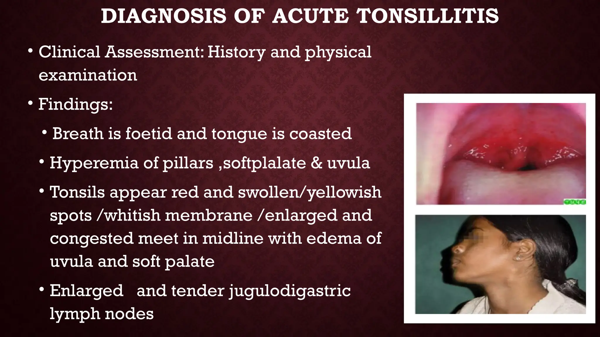 DISEASeS OF TONSILS pwrpoint presentation | PPTX