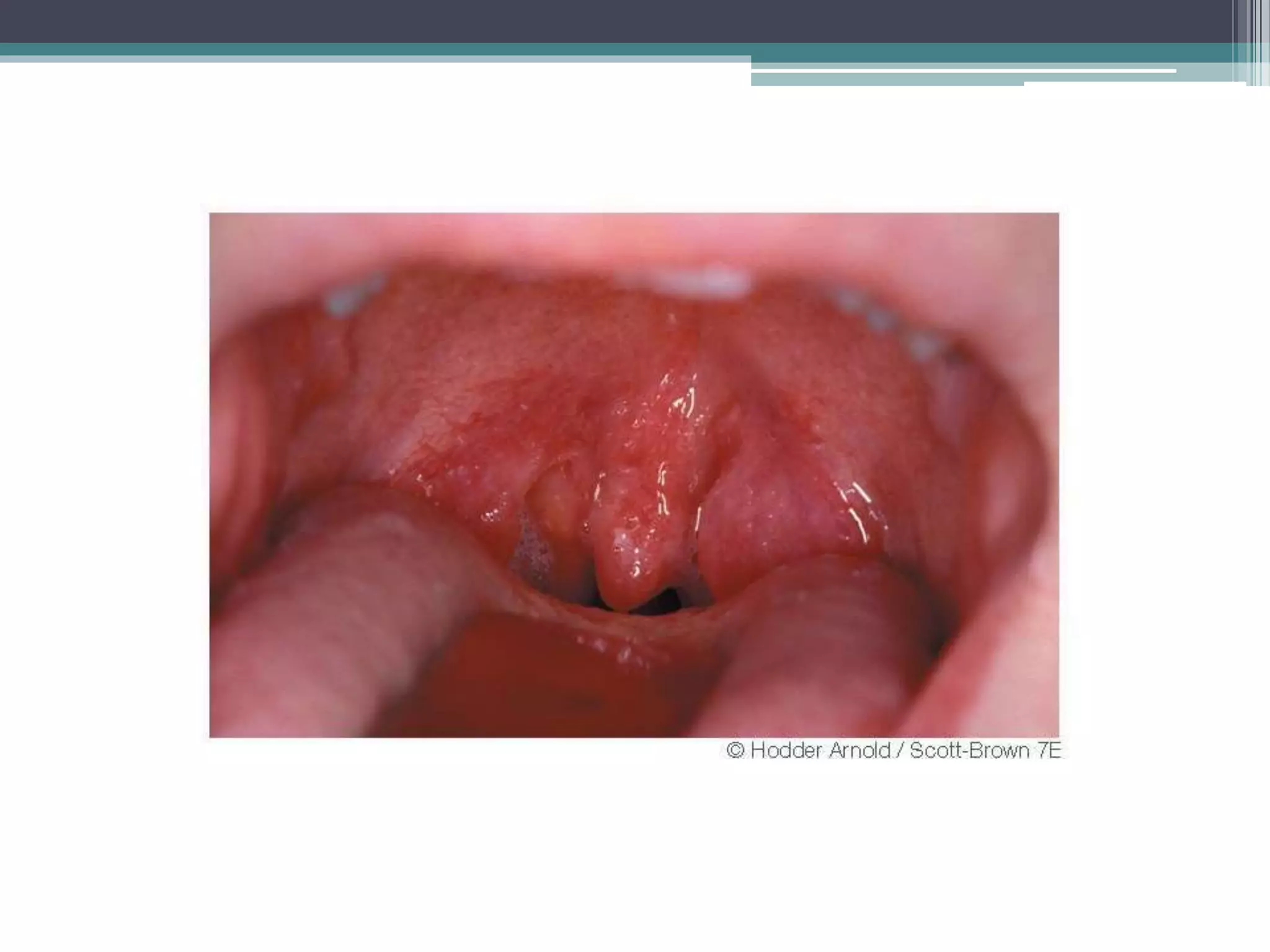 Diseases Of Tonsils And Adenoids Pptx 8207