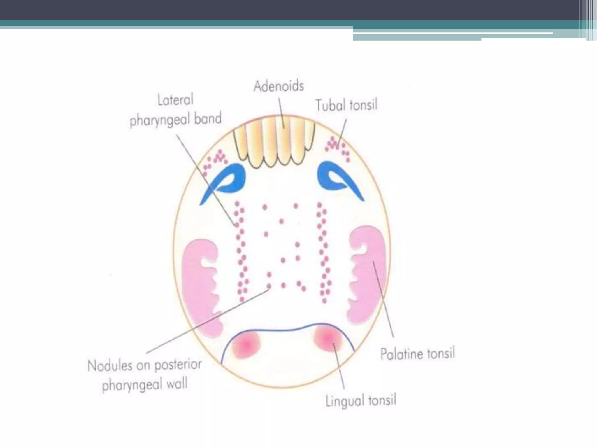 Diseases of tonsils and adenoids | PPTX