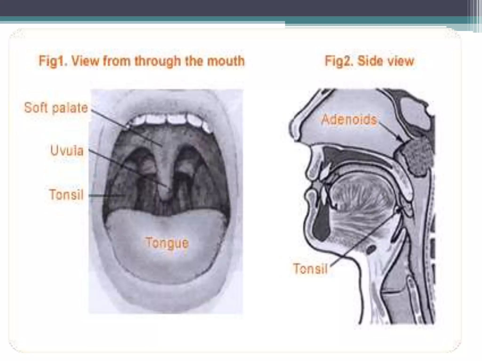Diseases of tonsils and adenoids | PPTX