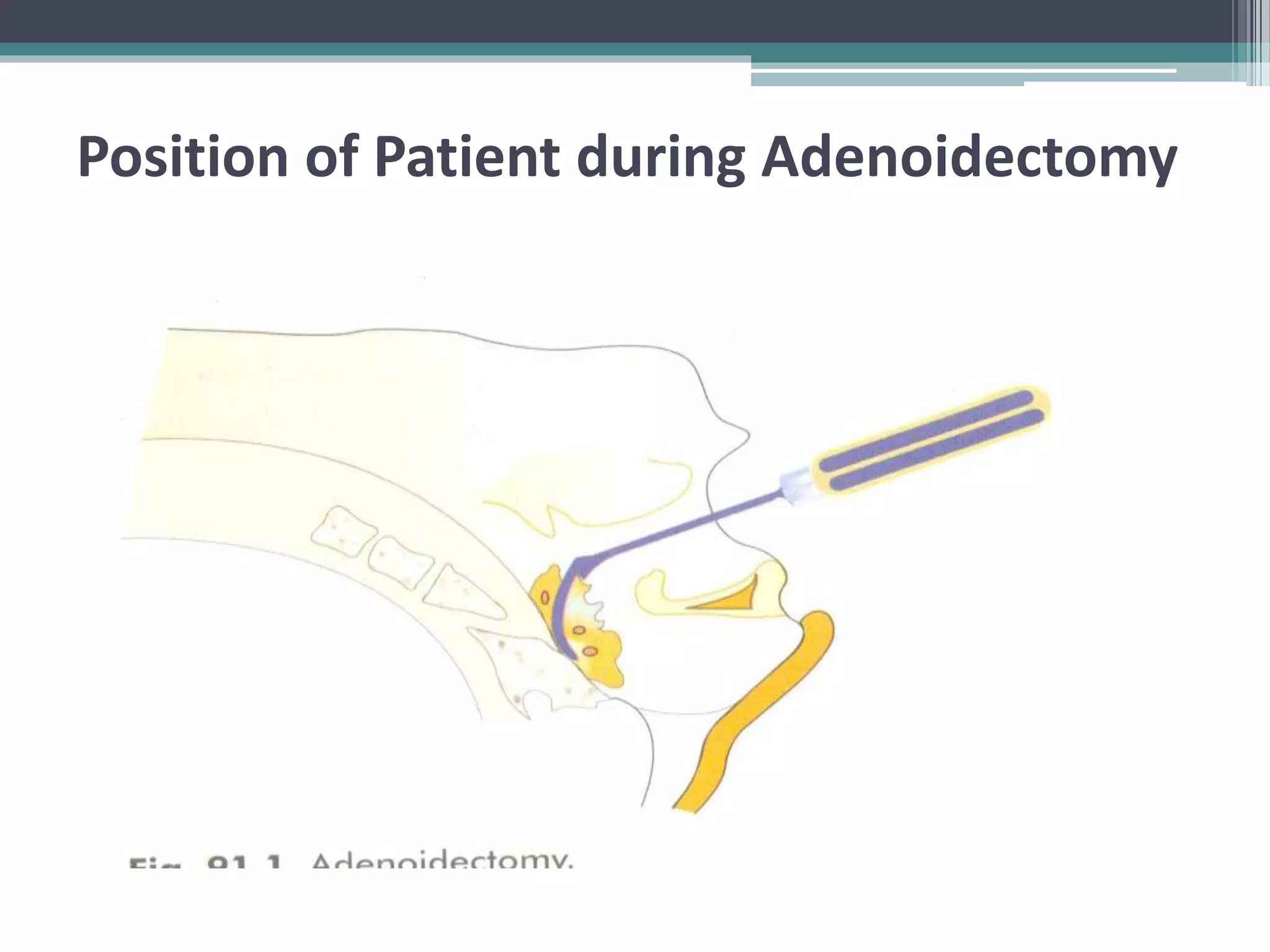 Diseases of tonsils and adenoids | PPTX