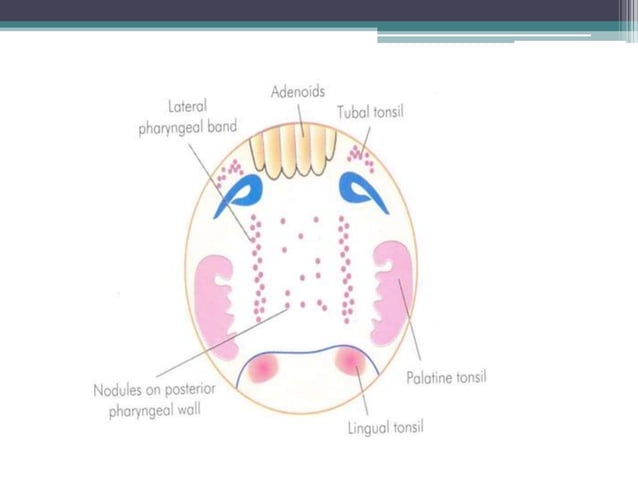 Diseases of tonsils and adenoids | PPTX | Ear, Nose and Throat ...