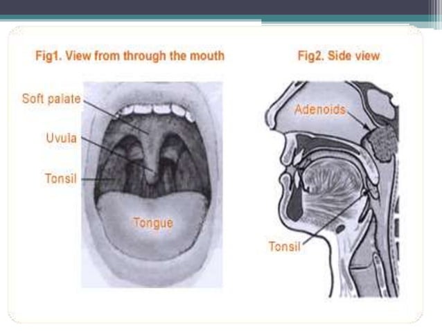 Diseases of tonsils and adenoids | PPTX | Ear, Nose and Throat Conditions | Diseases and Conditions