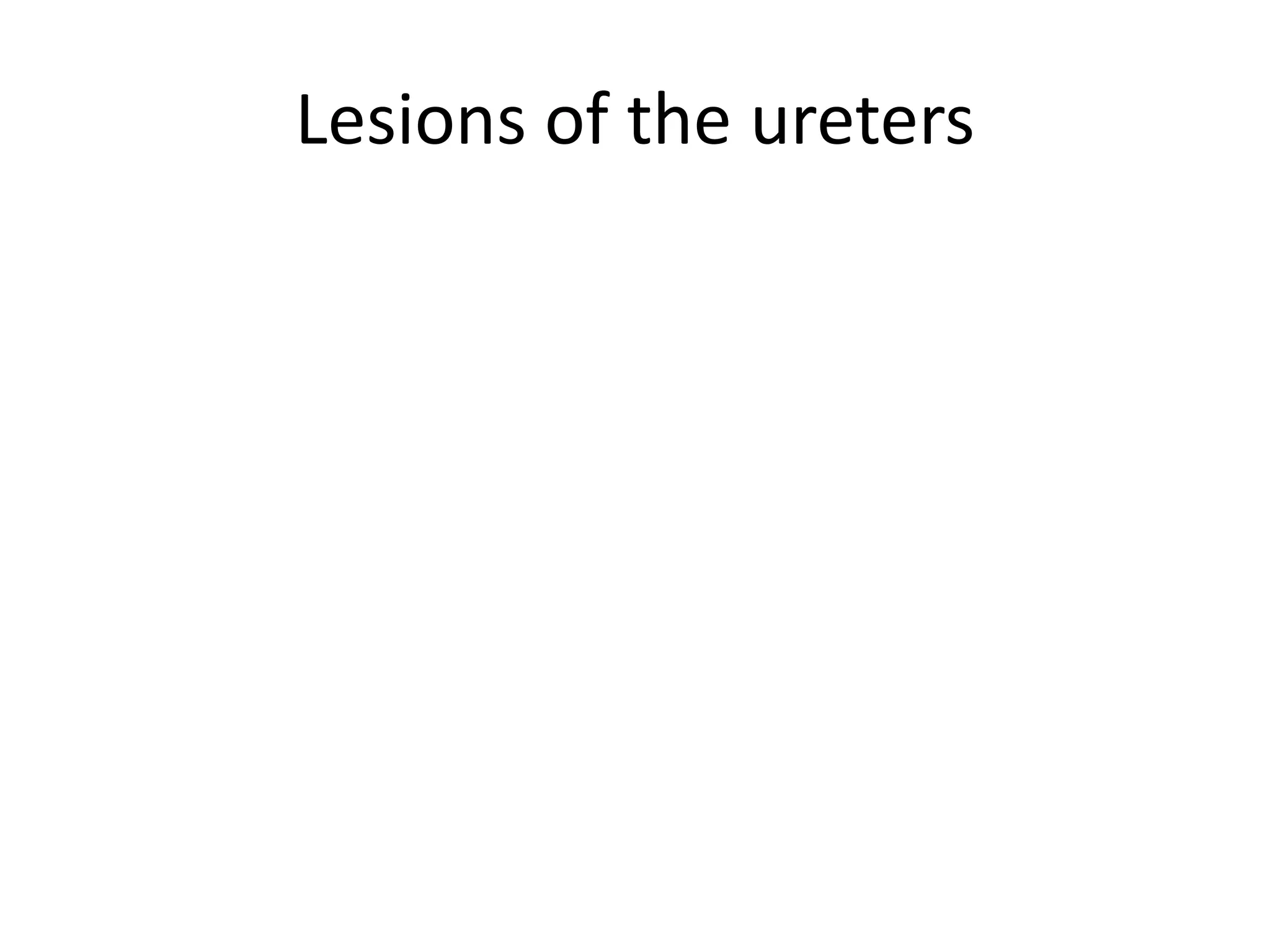 Diseases of ureters | PPTX