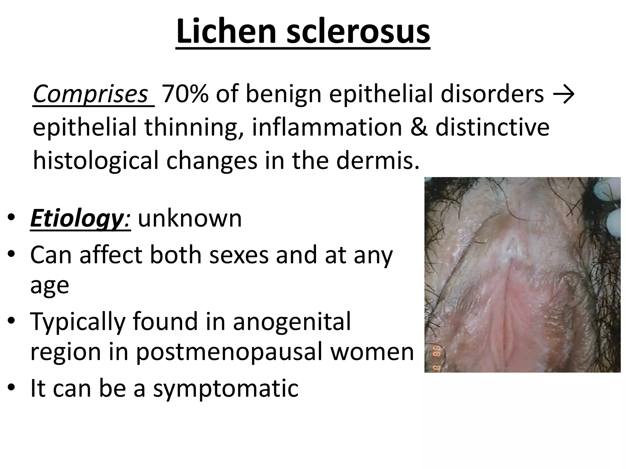 Diseases of vulva | PDF