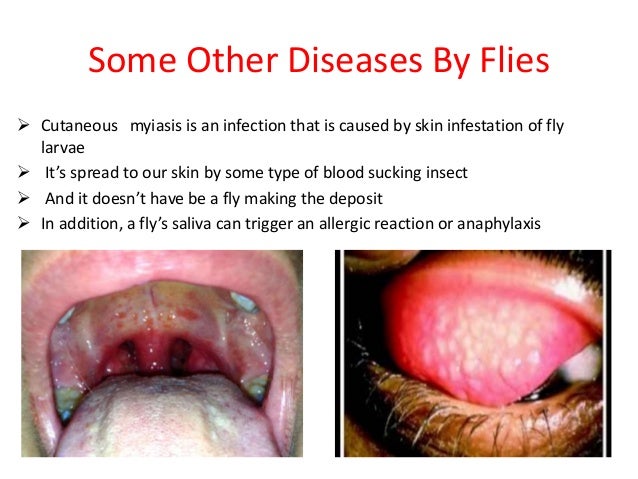Disease transmitted by flies