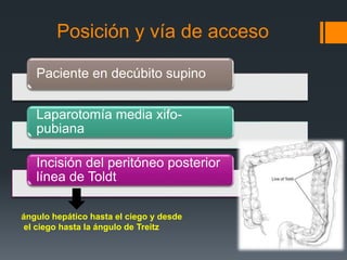 Diseccion de nódulo retroperitoneal | PPTX