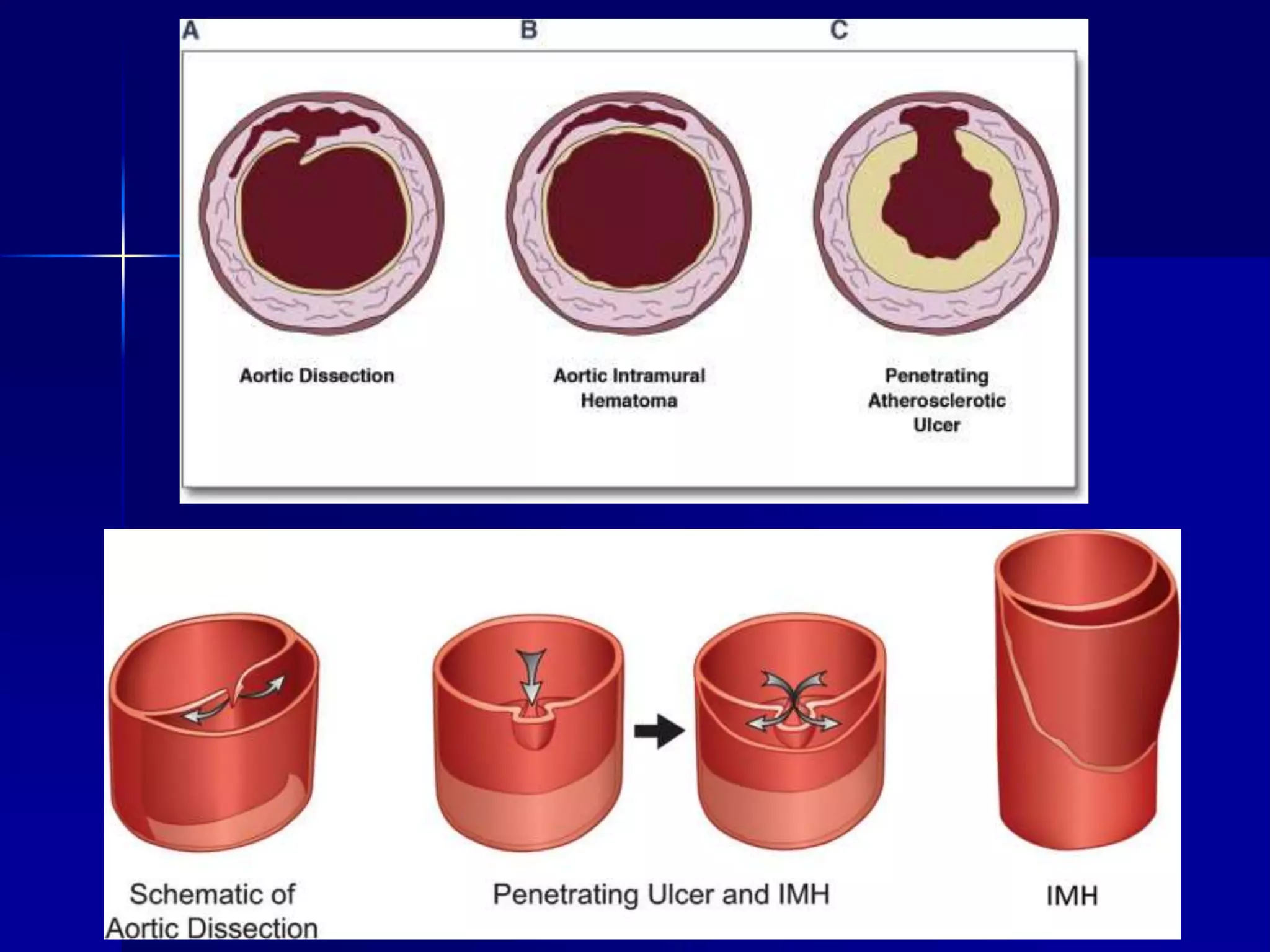 Aortic dissection GP | PPT