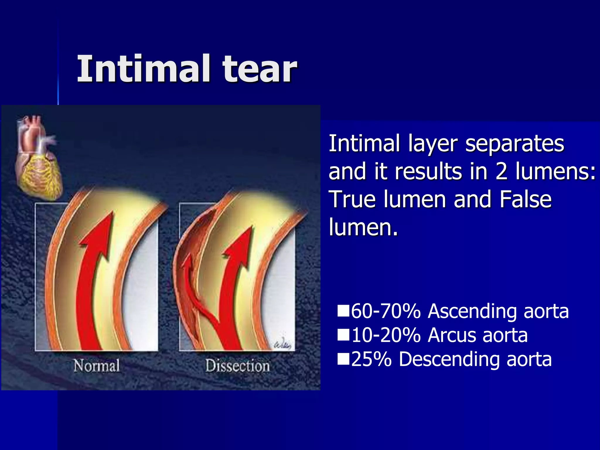 Aortic dissection GP | PPT