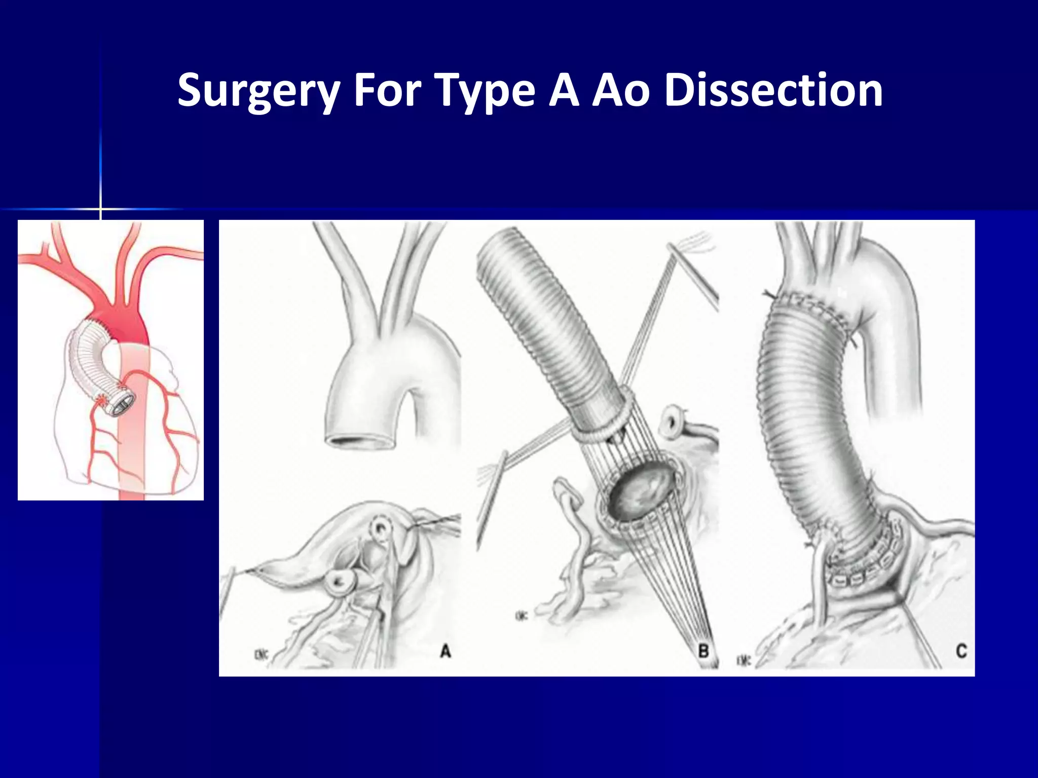 Aortic dissection GP | PPT