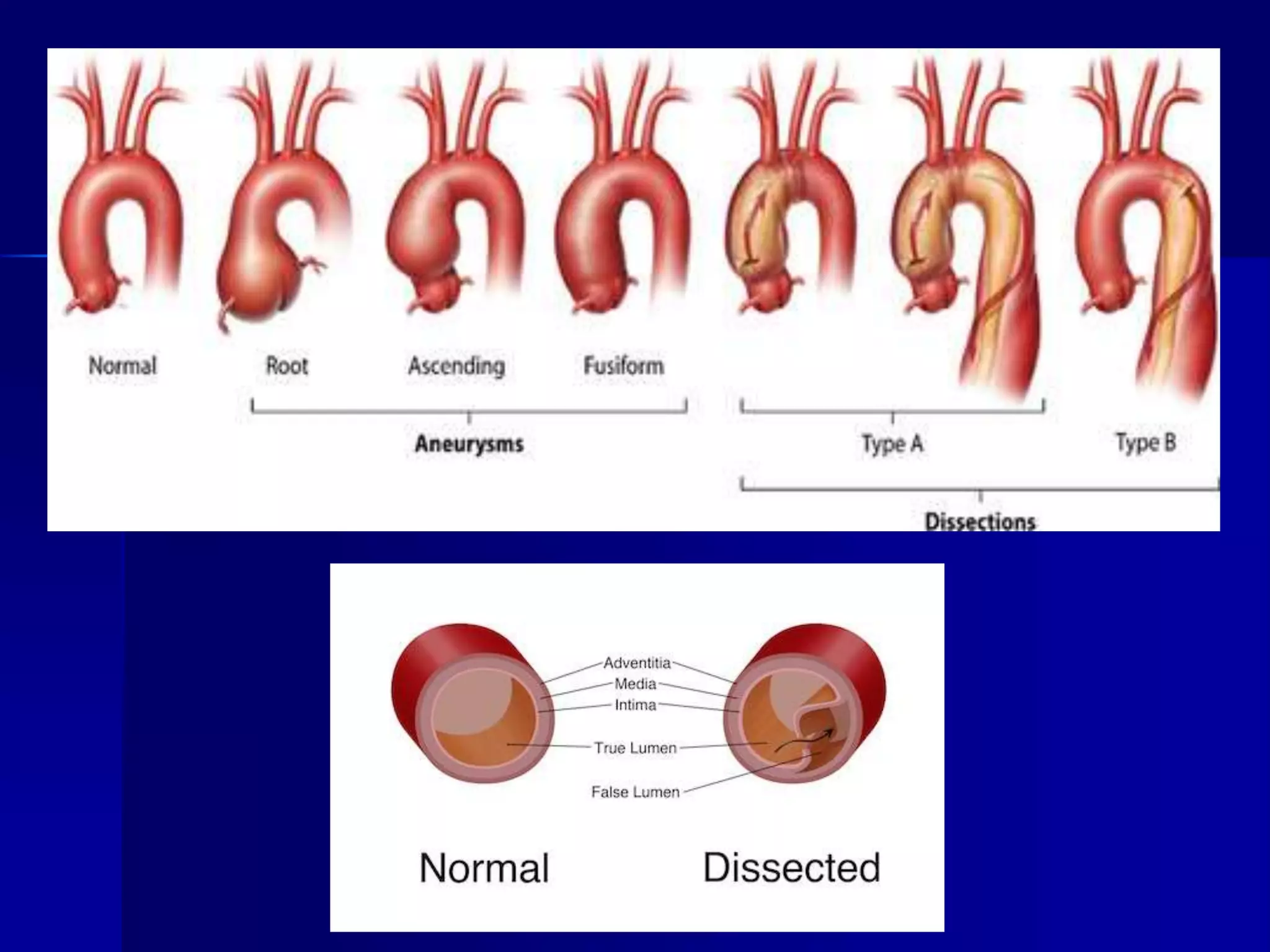 Aortic dissection GP | PPT