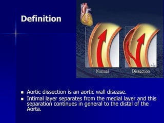 Aortic dissection GP | PPT