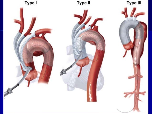 Aortic dissection GP