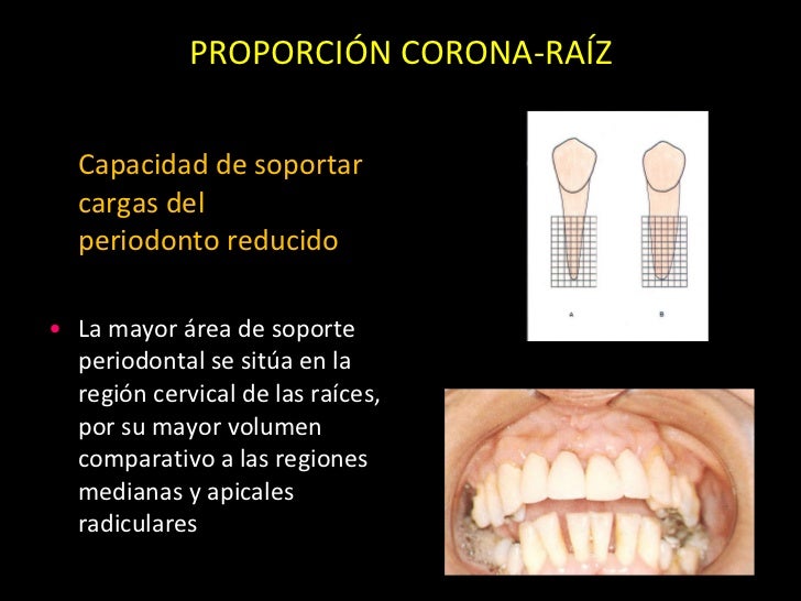 Diseño de protesis parcial fija 2