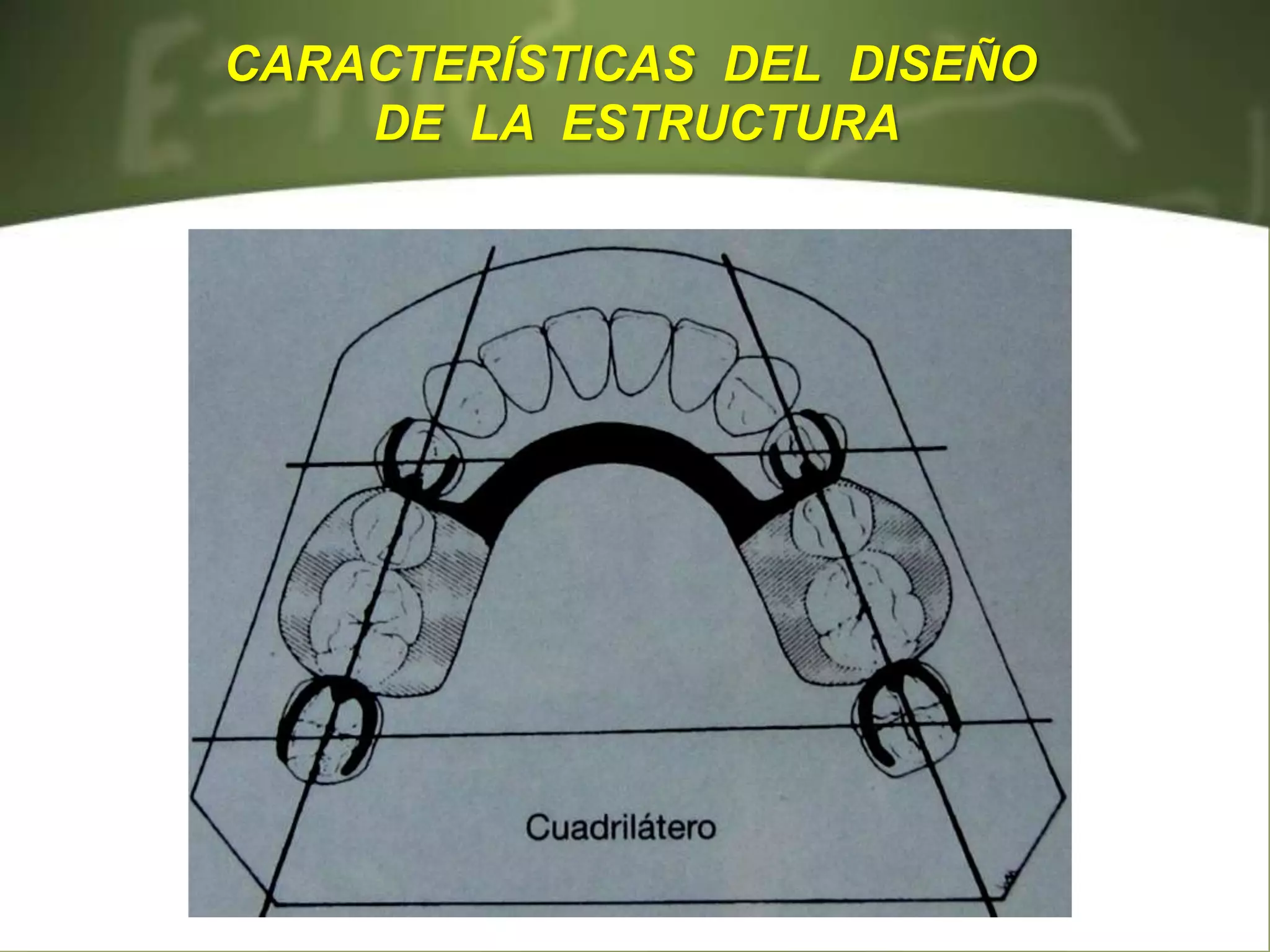 Diseño de protesis parcial removible