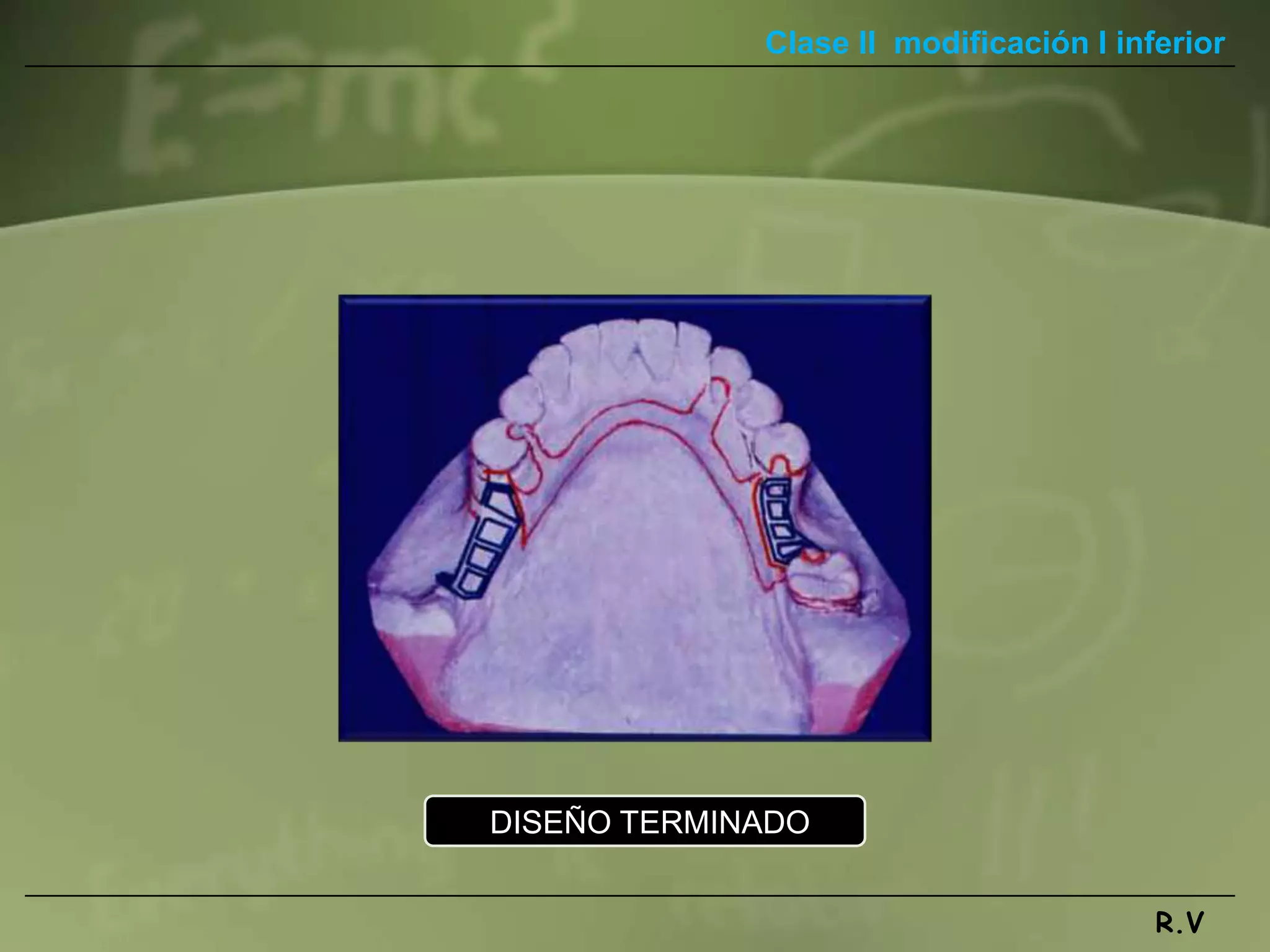 Diseño de protesis parcial removible