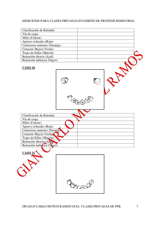 Diseño de protesis parcial removible