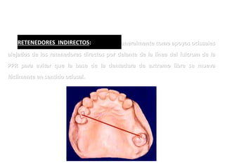 Diseño de protesis parcial removible | PPTX