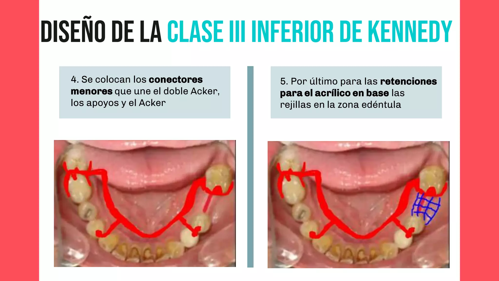 Diseños De Prótesis Parcial Removible Clase I Ii Ii Y Iv Pdf