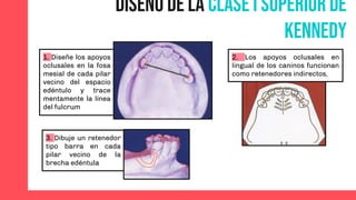 Diseños De Prótesis Parcial Removible Clase I Ii Ii Y Iv Pdf