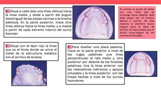 Diseños de Prótesis Parcial Removible - Clase I, II, II y IV | PDF