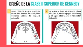 Diseños de Prótesis Parcial Removible - Clase I, II, II y IV | PDF