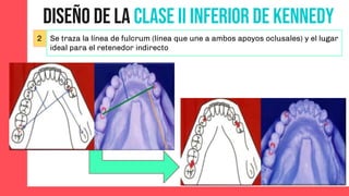 Diseños de Prótesis Parcial Removible - Clase I, II, II y IV | PDF