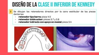 Diseños De Prótesis Parcial Removible Clase I Ii Ii Y Iv Pdf