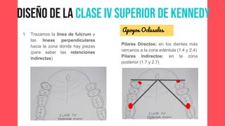 Diseños de Prótesis Parcial Removible - Clase I, II, II y IV | PDF