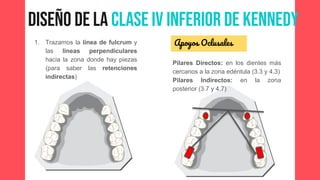 Diseños de Prótesis Parcial Removible - Clase I, II, II y IV | PDF