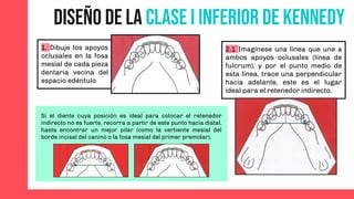 Diseños de Prótesis Parcial Removible - Clase I, II, II y IV | PDF