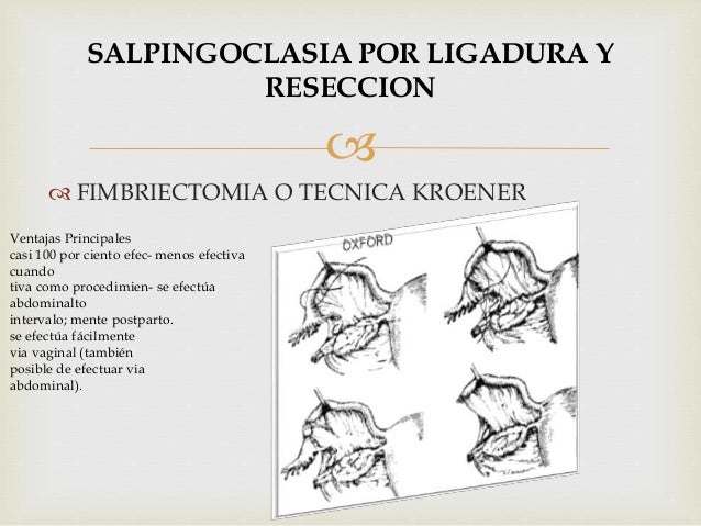 Disertacion sobre la trompa y tecnica de salpingoclastia, dr. ortega
