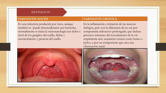 DISERYTACION DE FARINGITIS.pmmmmmmmmmmptx | PPT