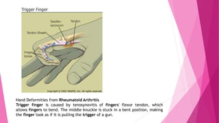 Disesases of locomotor system | PPT