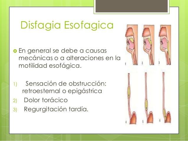 Disfagia Esofagica