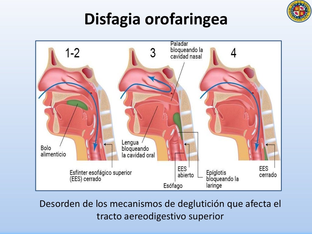DISFAGIA OROFARÍNGEA
