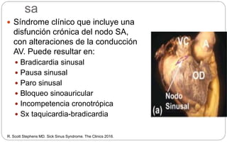 Disfunción del nodo sinusal.pptx