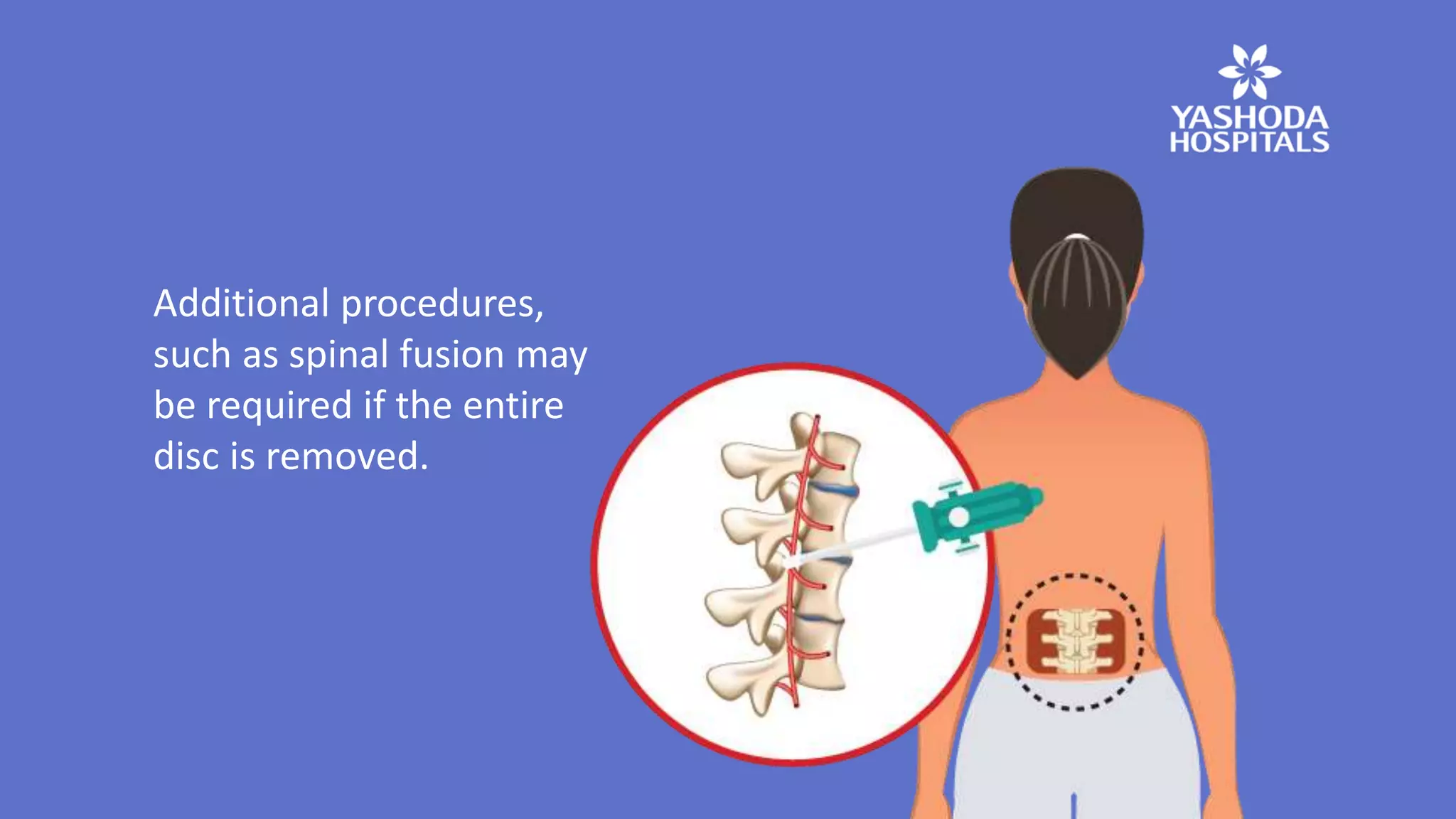 Spine Disc Surgeries - Discectomy and Decompression | PPTX