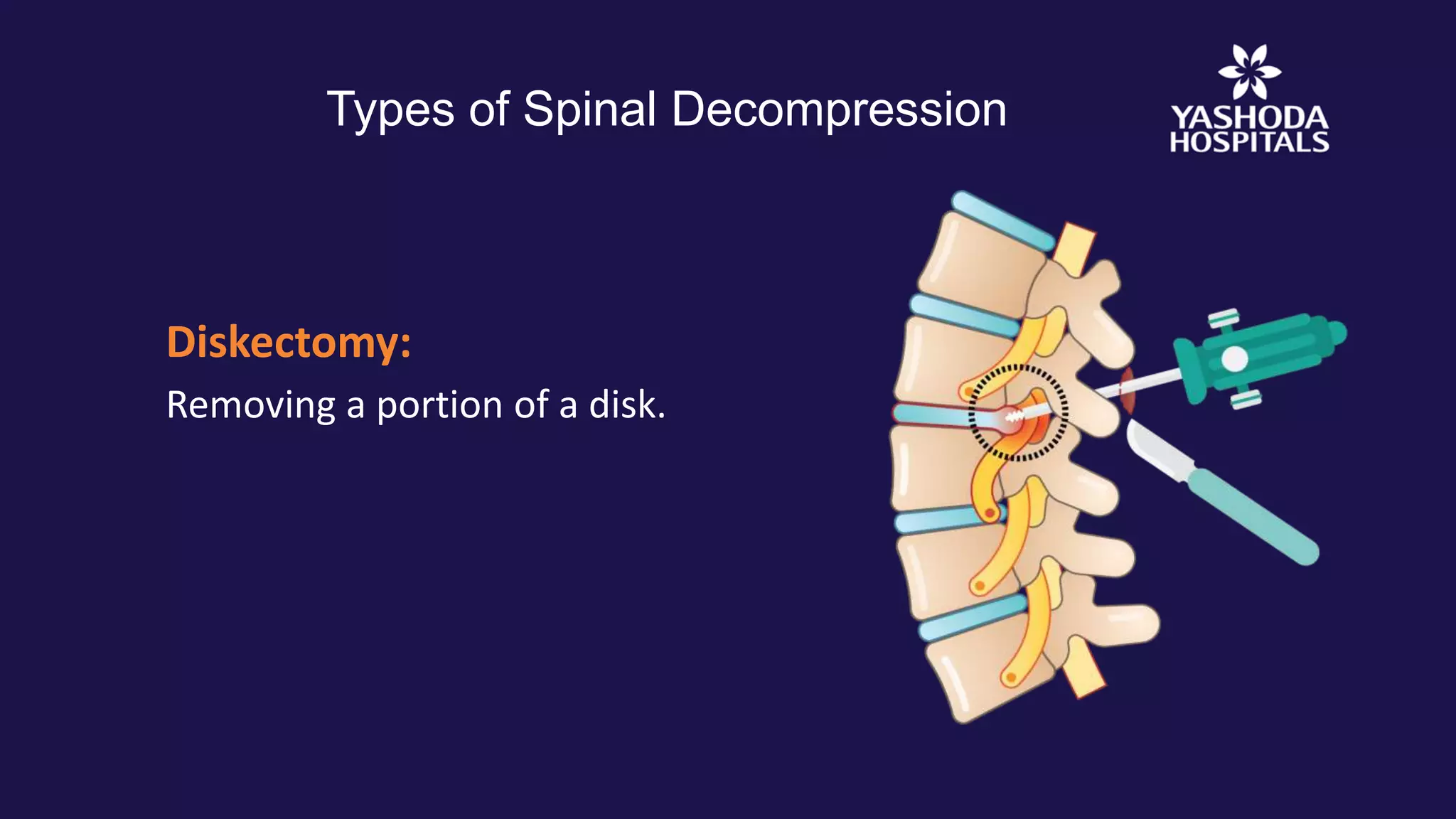 Spine Disc Surgeries - Discectomy and Decompression | PPTX