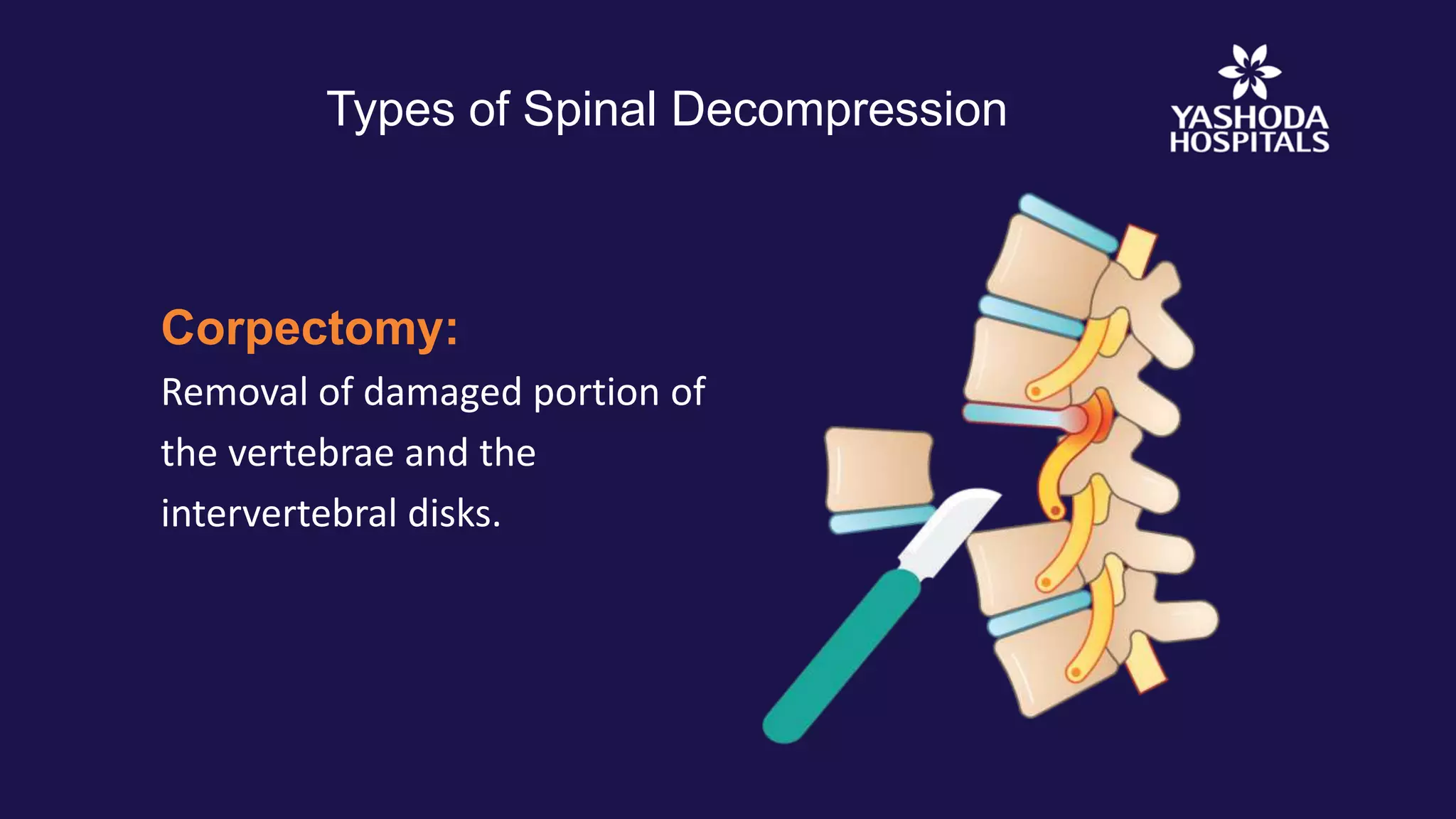 Spine Disc Surgeries - Discectomy and Decompression | PPTX