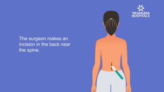 Spine Disc Surgeries - Discectomy and Decompression | PPTX