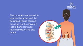 Spine Disc Surgeries - Discectomy and Decompression | PPTX