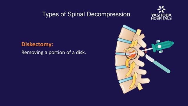Spine Disc Surgeries - Discectomy and Decompression | PPTX