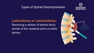 Spine Disc Surgeries - Discectomy and Decompression | PPTX
