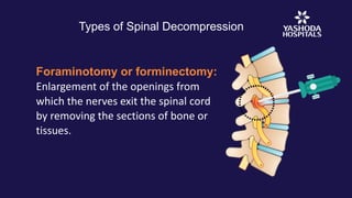 Spine Disc Surgeries - Discectomy and Decompression | PPTX