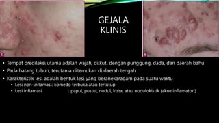 Diskusi Akne Vulgaris.pptx